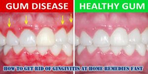 how to get rid of gingivitis at home Remedies Fast